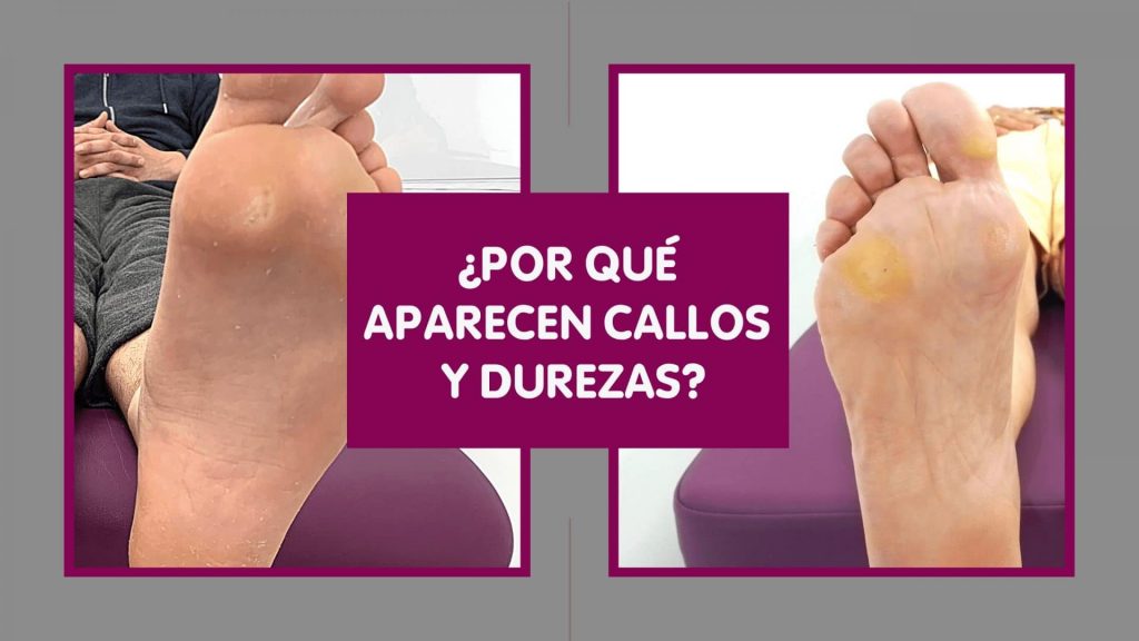 ¿Por qué aparecen callos y durezas en los pies? - Podoclínic Castellón ...